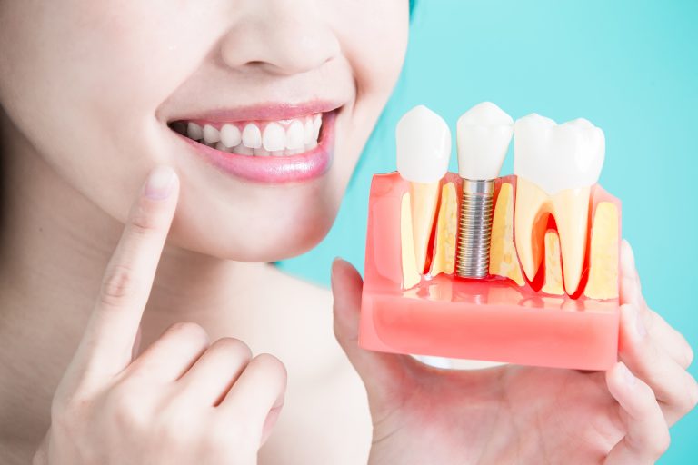 Bhandal Dental Practice – Dental Implants – West Midlands